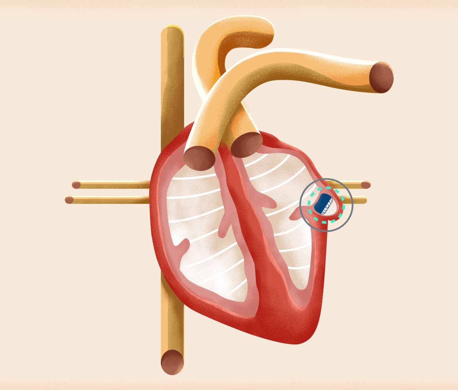 Watchman Procedure for Atrial Fibrillation – FixAfib